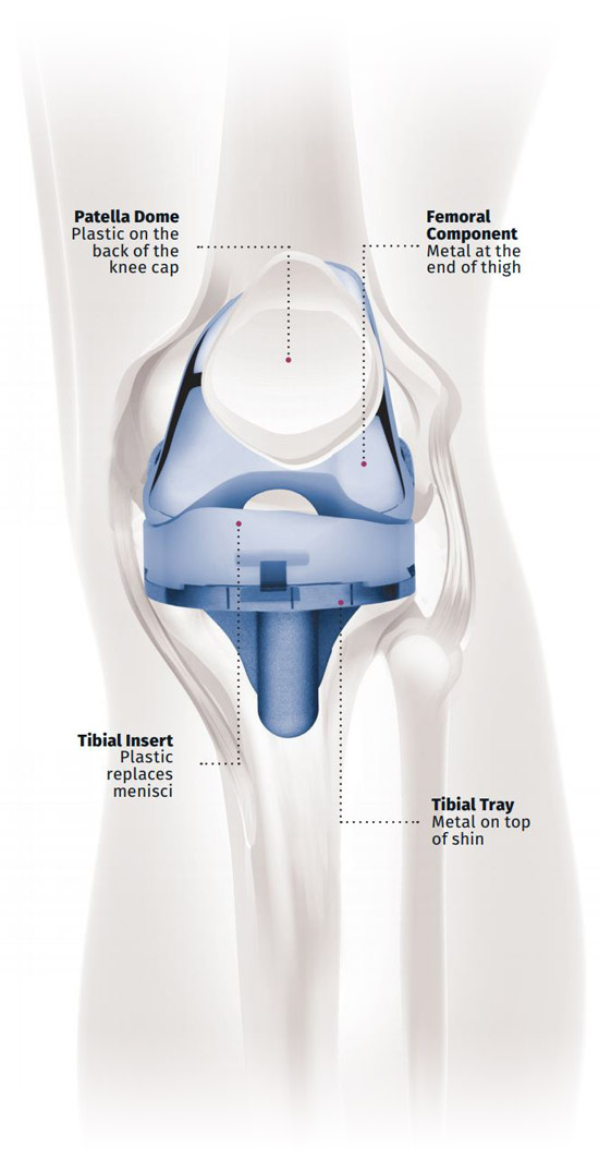 Understanding Total Knee Replacement MicroPort Orthopedics