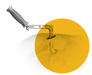 Path® Total Hip Approach | MicroPort Orthopedics