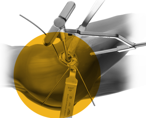 Direct Anterior Hip Approach | MicroPort Orthopedics