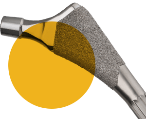 Profemur® Z revision hip stem | MicroPort Orthopedics