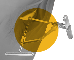 Profemur® TL hip stem | MicroPort Orthopedics